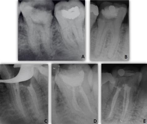 A Initial Radiograph Of Teeth 36 And 37 B Initial Radiograph Of