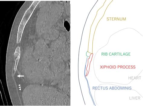 Xiphodynia With Limited Decrease In The Xiphoid Process Sternal Angle But Recognised Compression Xiphodynia With Limited Decrease In The Xiphoid Process Sternal Angle But Recognised Compression