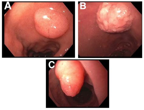 Mo1304 Foveolar Gastric Metaplasia Of The Duodenum An Endoscopic