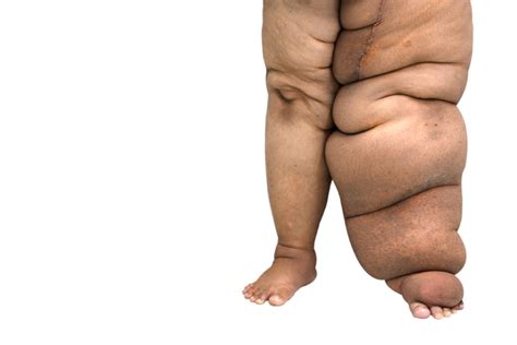 Filariasis Treatment In Hyderabad Elephantiasis Treatment