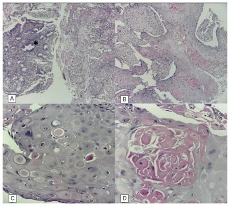 Primary Squamous Cell Carcinoma Of The Gallbladder With Hepatic
