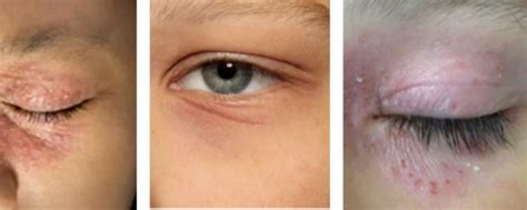 Dermatitis Periocularis Rode Uitslag Rond Ogen Sproet