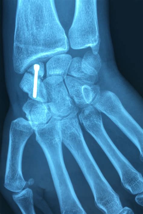 Pseudarthrose Scaphoide Medipole Toulouse Institut De La Main Medipole Toulouse