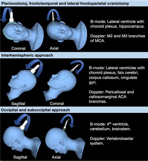 Recommended Orthogonal Ultrasound Fans For Different Craniotomies With