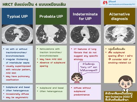 รู้ไว้ไอแอลดี Hrct Categories ยังเหมือนเดิม เพิ่มเติมและปรับเล็กน้อย