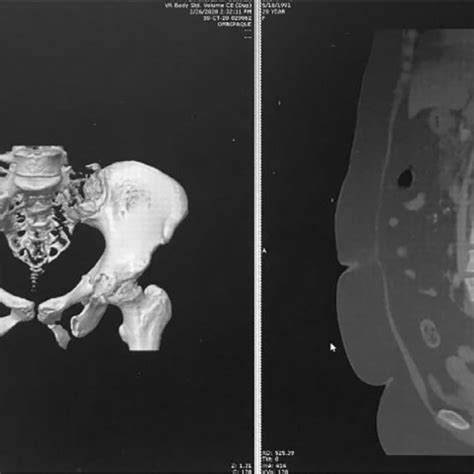 Once The Gluteus Maximus Musclocutaneous Flap Was Dissected And Download Scientific Diagram