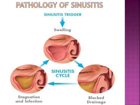 Ent Sinusitistreatment And Diagnosis