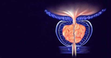 Prostatitis Bacteriana Aguda Homo Medicus