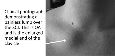 Sternoclavicular Joint Swelling