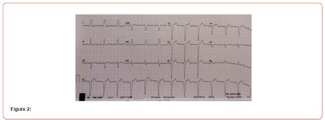 Complete Atrioventricular Block In A 22 Year Old Woman Case Report Iris Publishers