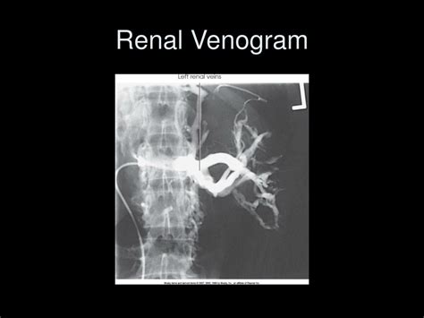 Ppt Venography And Lymphography Powerpoint Presentation Free Download