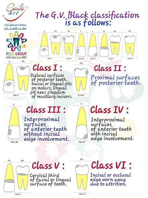Classification Of Dental Fillings At Stephanie Watt Blog
