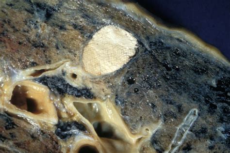 Caseous Necrosis Gross