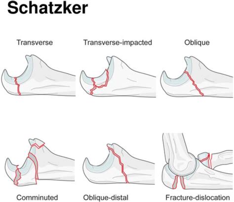 Proximal Ulna Fractures In Adults A Review Of Diagnosis And Management