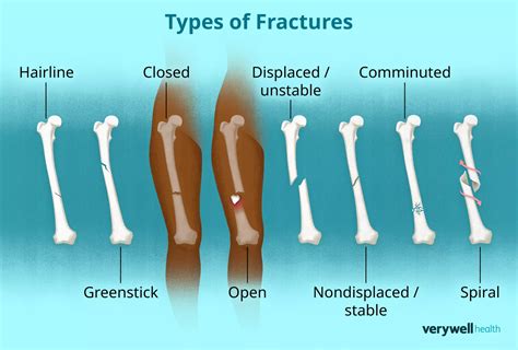 Injury Settlements For Fractures Crush Injuries And Dislocations Genthe Law Firm Pc