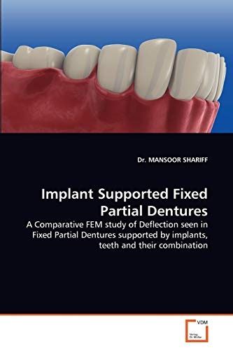 Implant Supported Fixed Partial Dentures A Comparative Fem Study Of