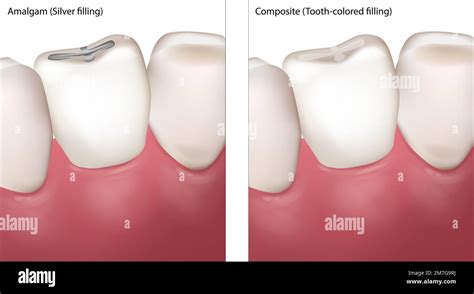 Dental Filling Procedure Amalgam Silver Filling And Composite Tooth