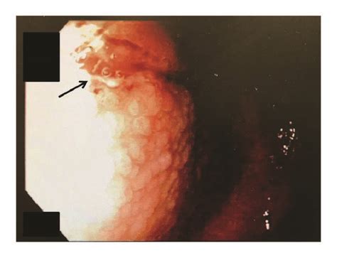 Endoscopic Photos Of The Body Of The Stomach Show Diffusely Nodular Download Scientific Diagram