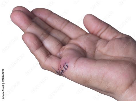 Hand Injured By A Cut Surgical Suture Made By A Surgeon On White
