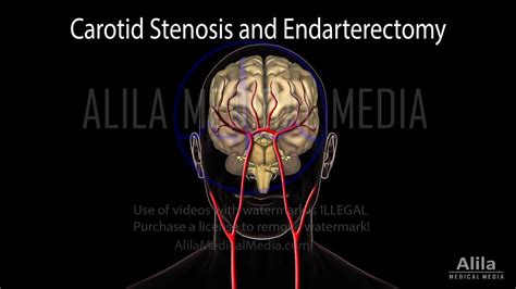 Alila Medical Media Carotid Stenosis And Endarterectomy Narrated
