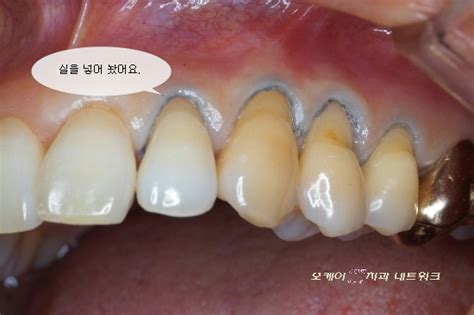 잇몸부위가 파인치아의 레진치료 네이버 블로그