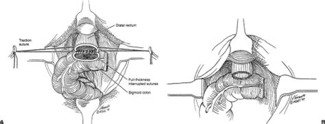 J Pouch Rectal Cancer