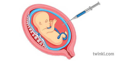Amniocentesis Diagram