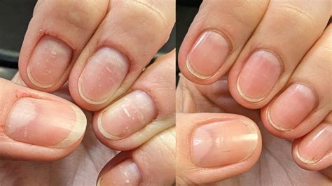 Nail Fold Question 6 Weeks In Rcalmhands
