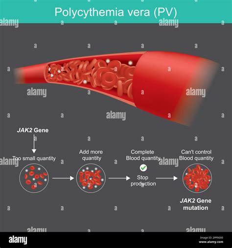 Polycythemia Vera Too Much Red Blood Cells Have In Blood Vessel And