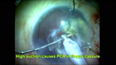 Retained Cortex Volume 32 Issue 3 Video Journal Of Cataract