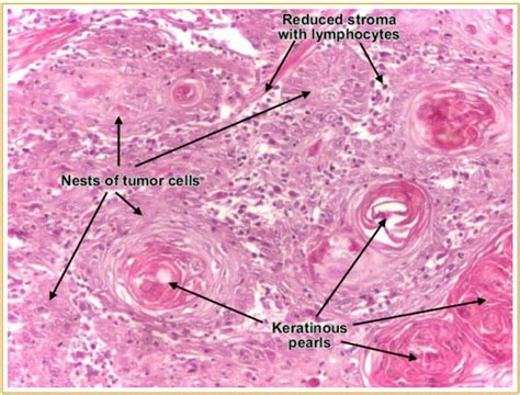 Squamous Cell Carcinoma Of Skin Medizzy