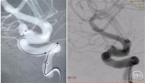 Time To Evolve 超越之旅 厦门大学附属中山医院完成福建省首例surpass Evolve植入 脑医汇