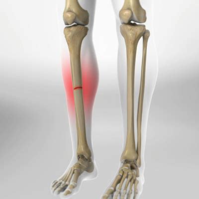 Tibia Bone Fracture Orthopro Clinic