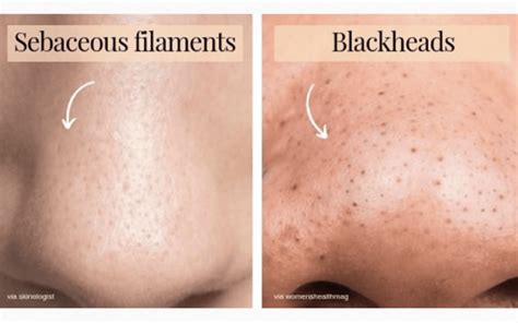 Introducing New Services Vascular Lesions And Sebaceous Filaments
