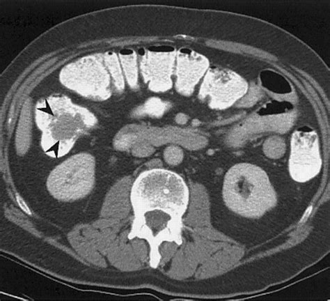 Polyps In Colon Ct Scan At Darla Adkins Blog
