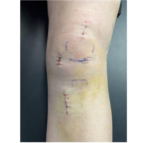 When Acl Surgery Doesnt Go As Planned Racl