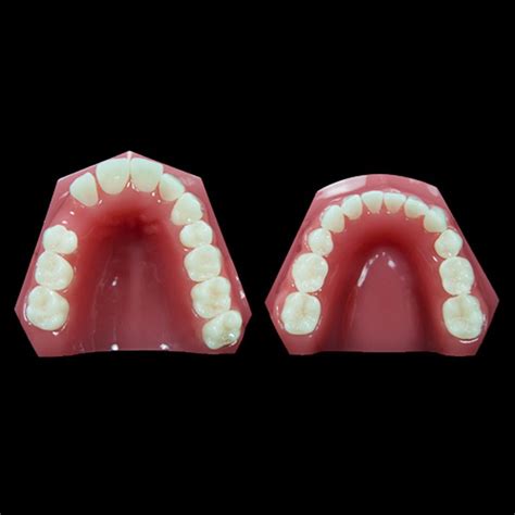 Or 17e Mixed Dentition Class Ii Division 1 Excessive Overbite