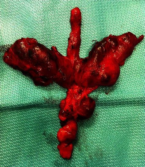 Risk Of Lymph Node Metastases In Multifocal Papillary Thyroid Cancer