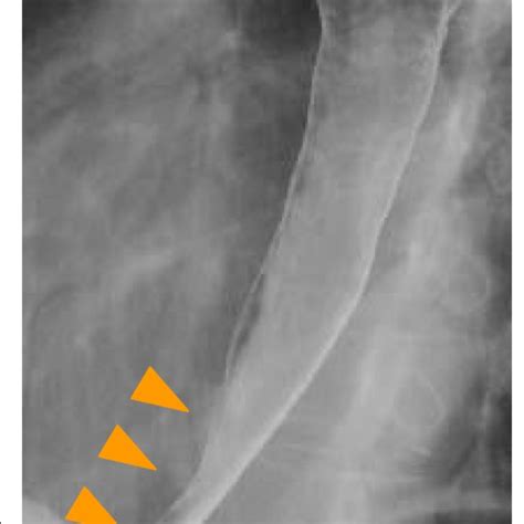 Esophagography Revealed The Smooth Stenosis At The Lower Esophagus Download Scientific Diagram