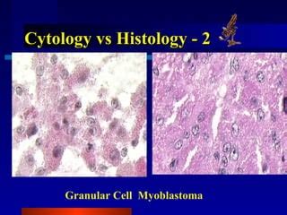 Fine Needle Aspiration Cytology Biopsy Ppt Ppt