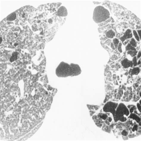 A Chest Radiograph Showing Bilateral Diffuse Miliary Nodular Lesions Download Scientific