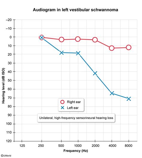 Vestibular Schwannoma Acoustic Neuroma Ear Nose And Throat Uworld