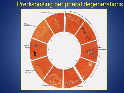 Ppt Pathogenesis And Signs Of Retinal Detachment Powerpoint