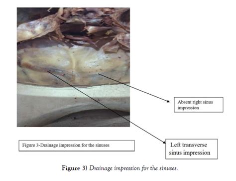 Superior Sagittal Sinus Draining Only To The Left Transverse Sinus