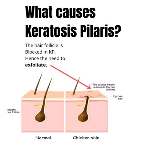 Keratosis Pilaris Causes Kératose Pilaire Traitement Ajruz