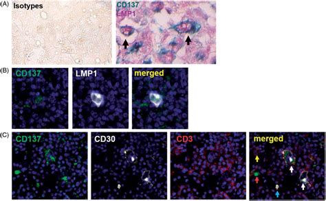 Lmp1 And Cd137 Are Coexpressed In Hodgkin Lymphoma A A Tissue