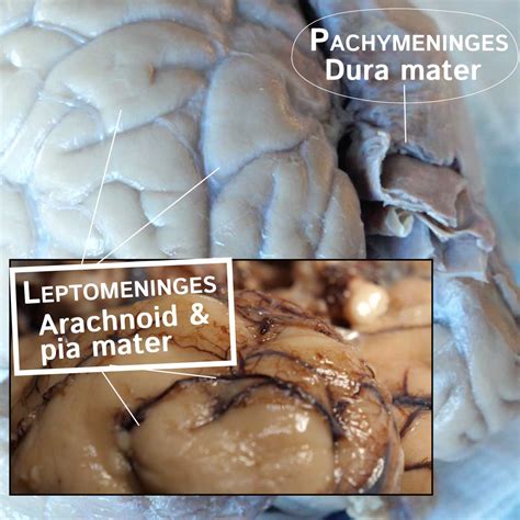 Neuroanatomy Glossary Arachnoid Mater Ditki Medical And Biological