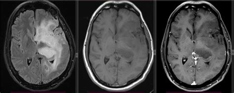 Dr Raj C On Linkedin Low Grade Diffuse Glioma Non Enhancing