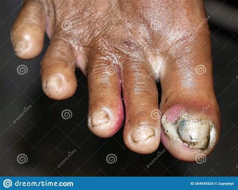 Fungal Infection Called Tinea Pedis And Paronychia At Toes Royalty Free