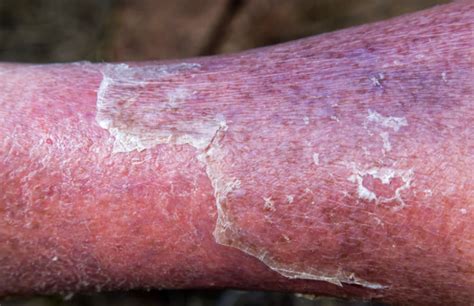Cellulitis Bacterial Skin Soft Tissue Infection Disease Causes Symptoms Management Methods